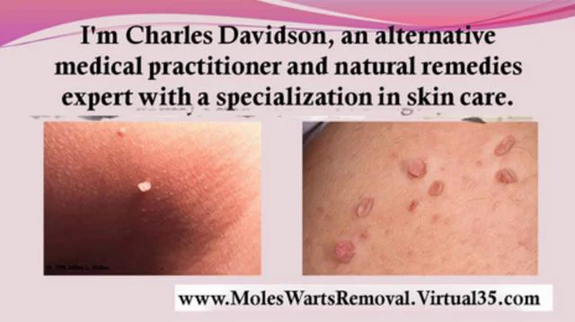 skin tags removal at home - skin tag removal at home - plantar warts ...
