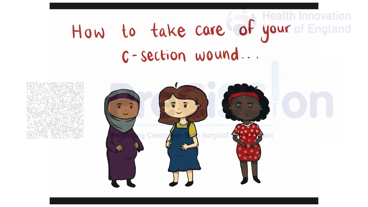 Caring for your wound after a Caesarean Section