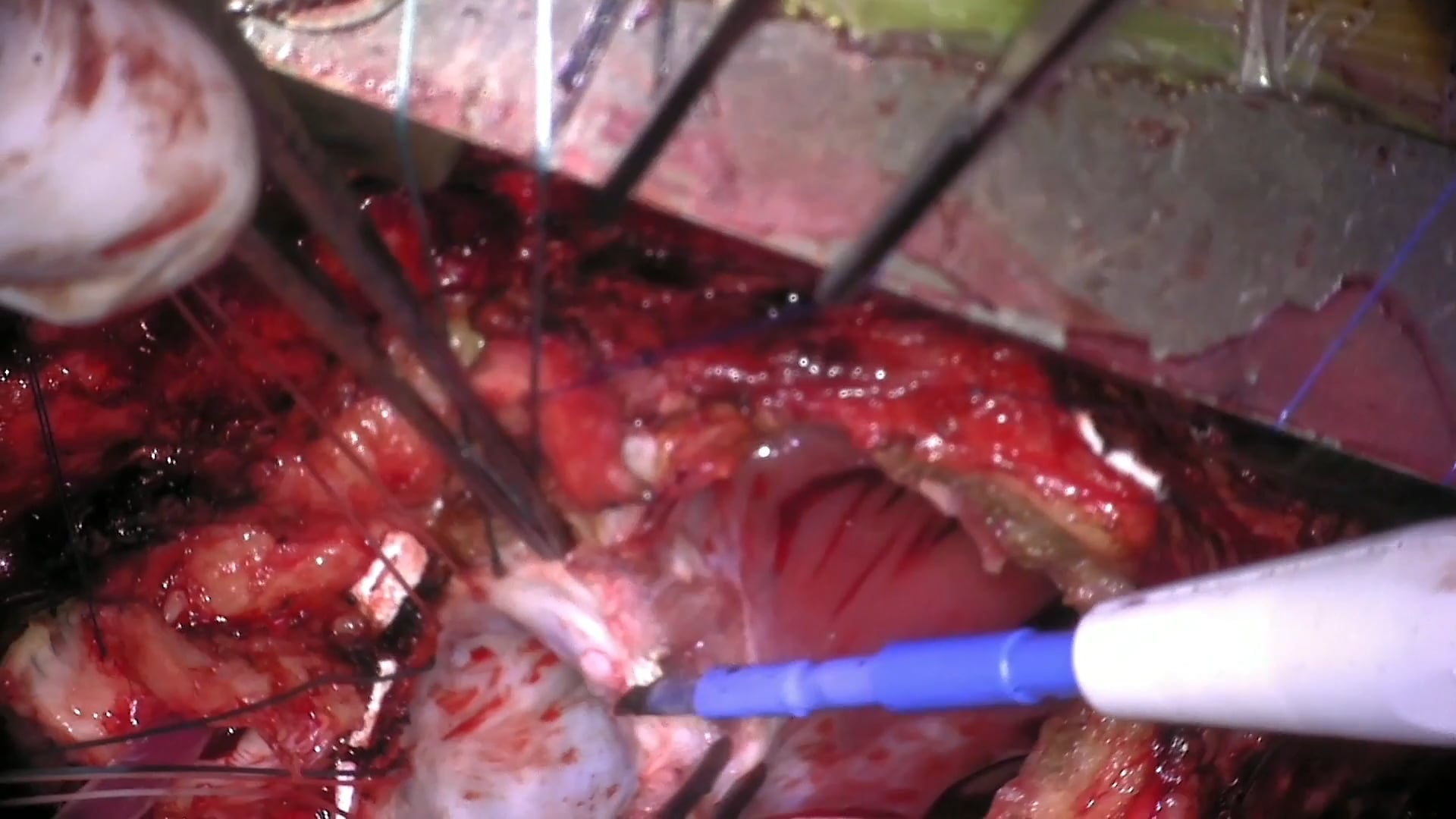 Third sternotomy with modified Bentall/Konno procedure for recurrent ...