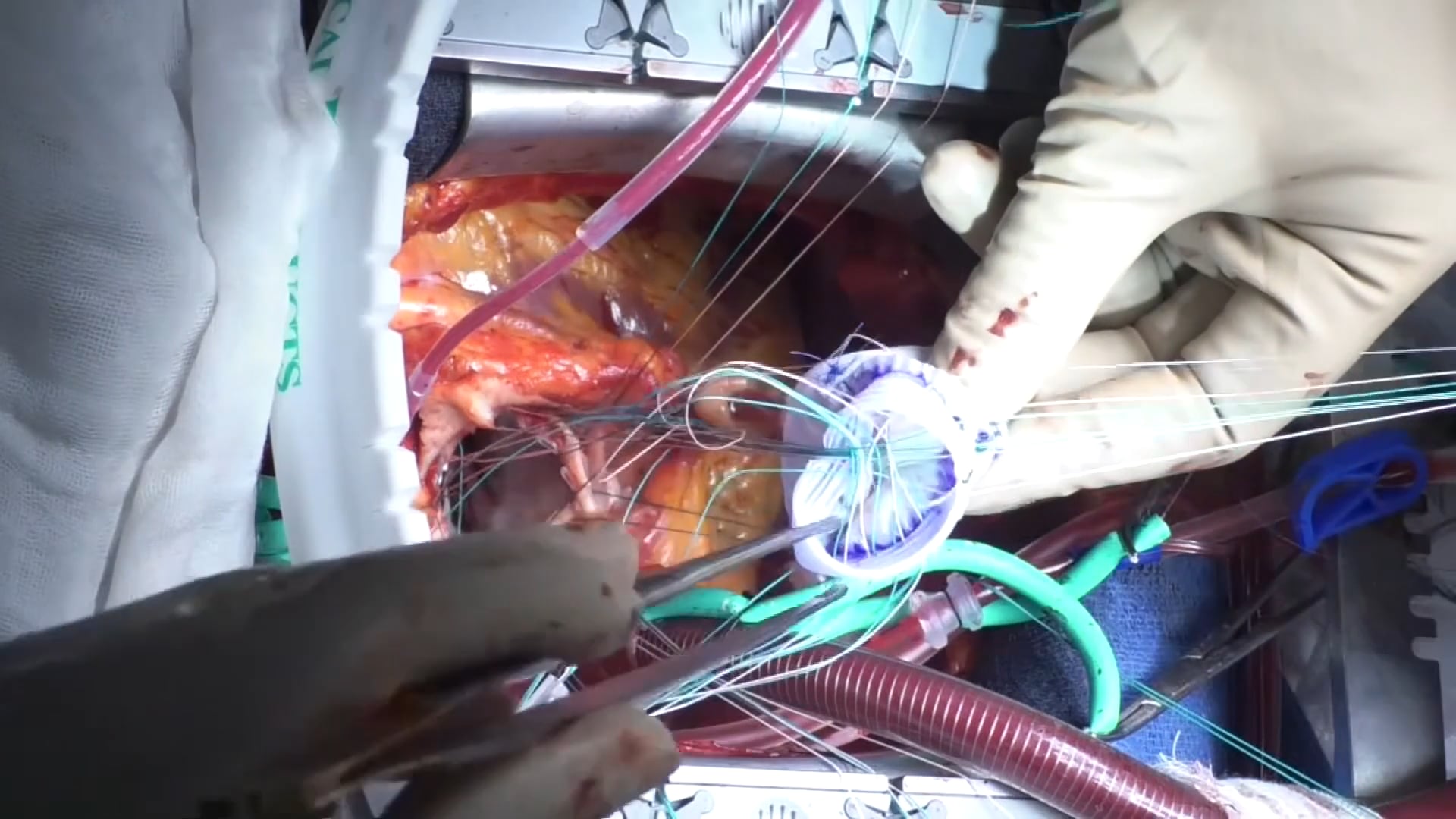 Innovative combined Ozaki and Bentall procedures for aortic root ...