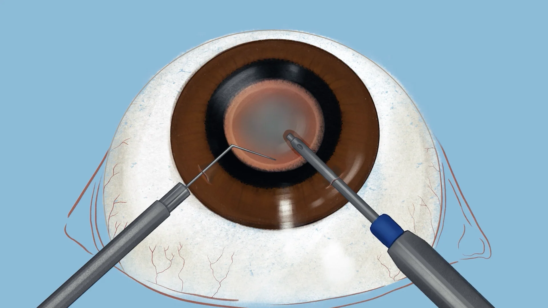 What To Expect From Your Cataract Surgery