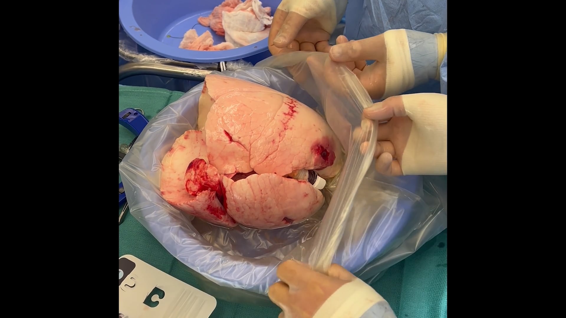 Paediatric donor lung preservation using Paragonix BAROguard | MMCTS