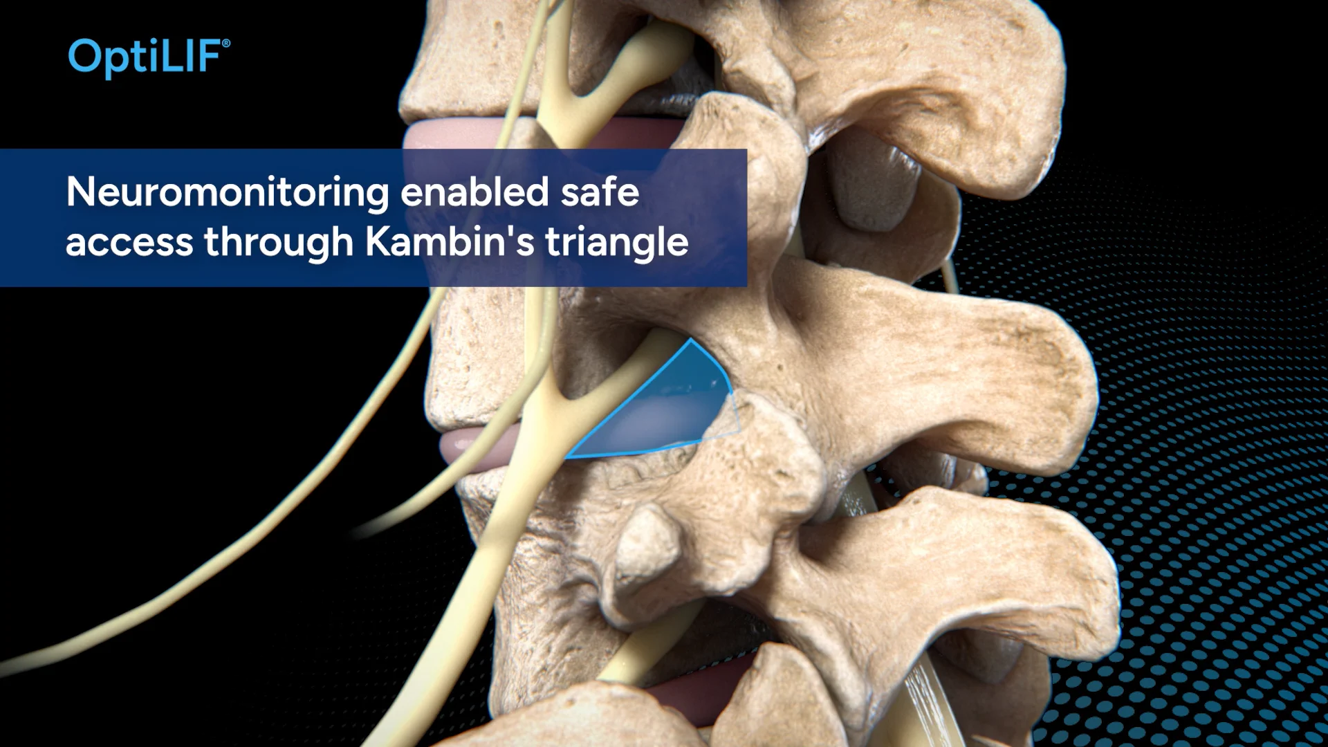 OptiLIF® with the OptiMesh® Expandable Interbody Fusion System