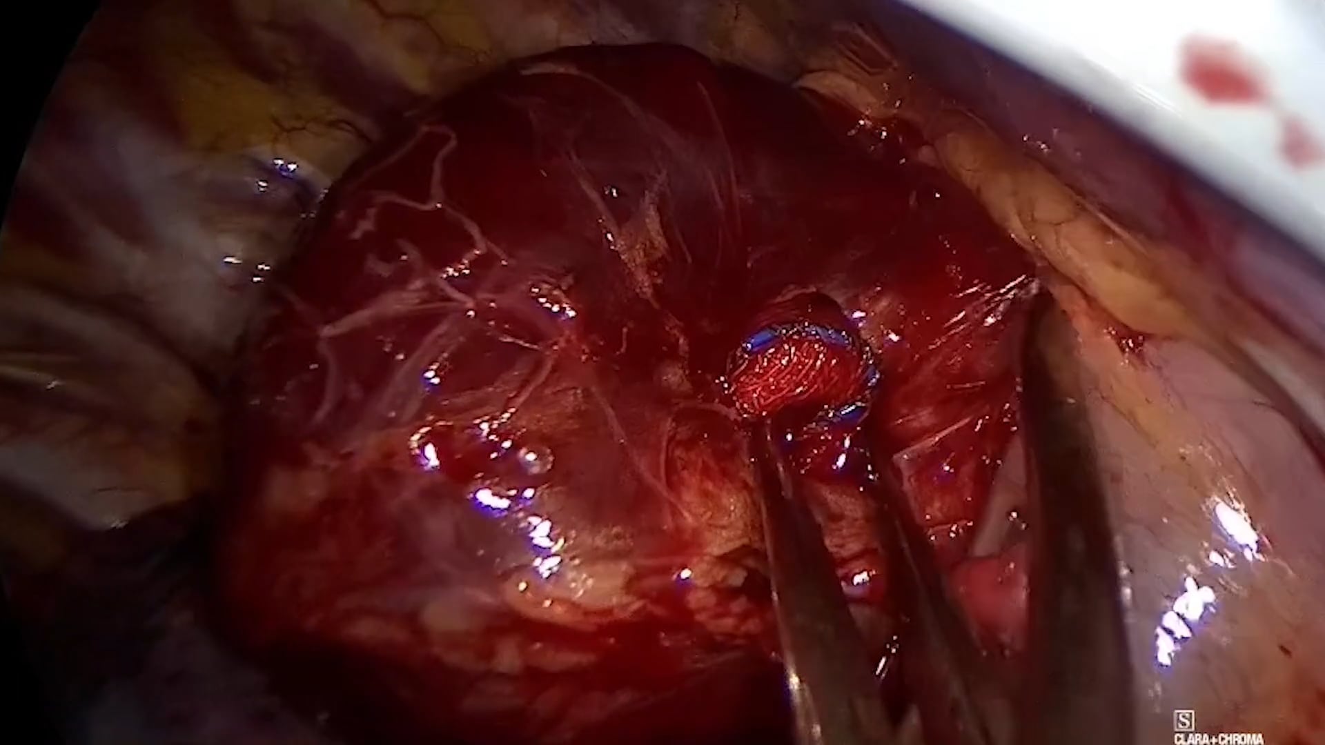 Uniportal VATS removal of a giant mediastinal goitre | MMCTS