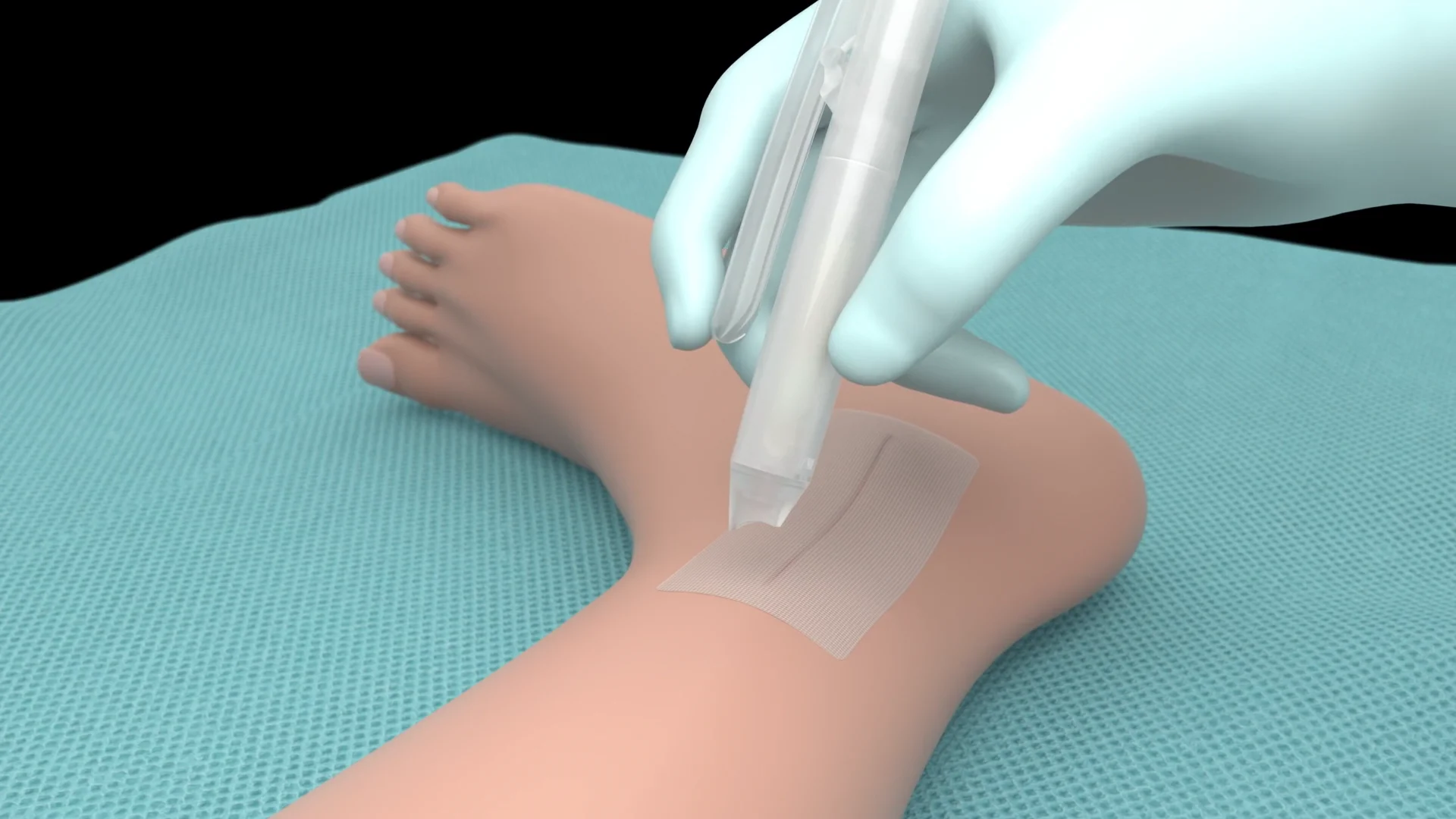 Cutiva PLUS Skin Closure System