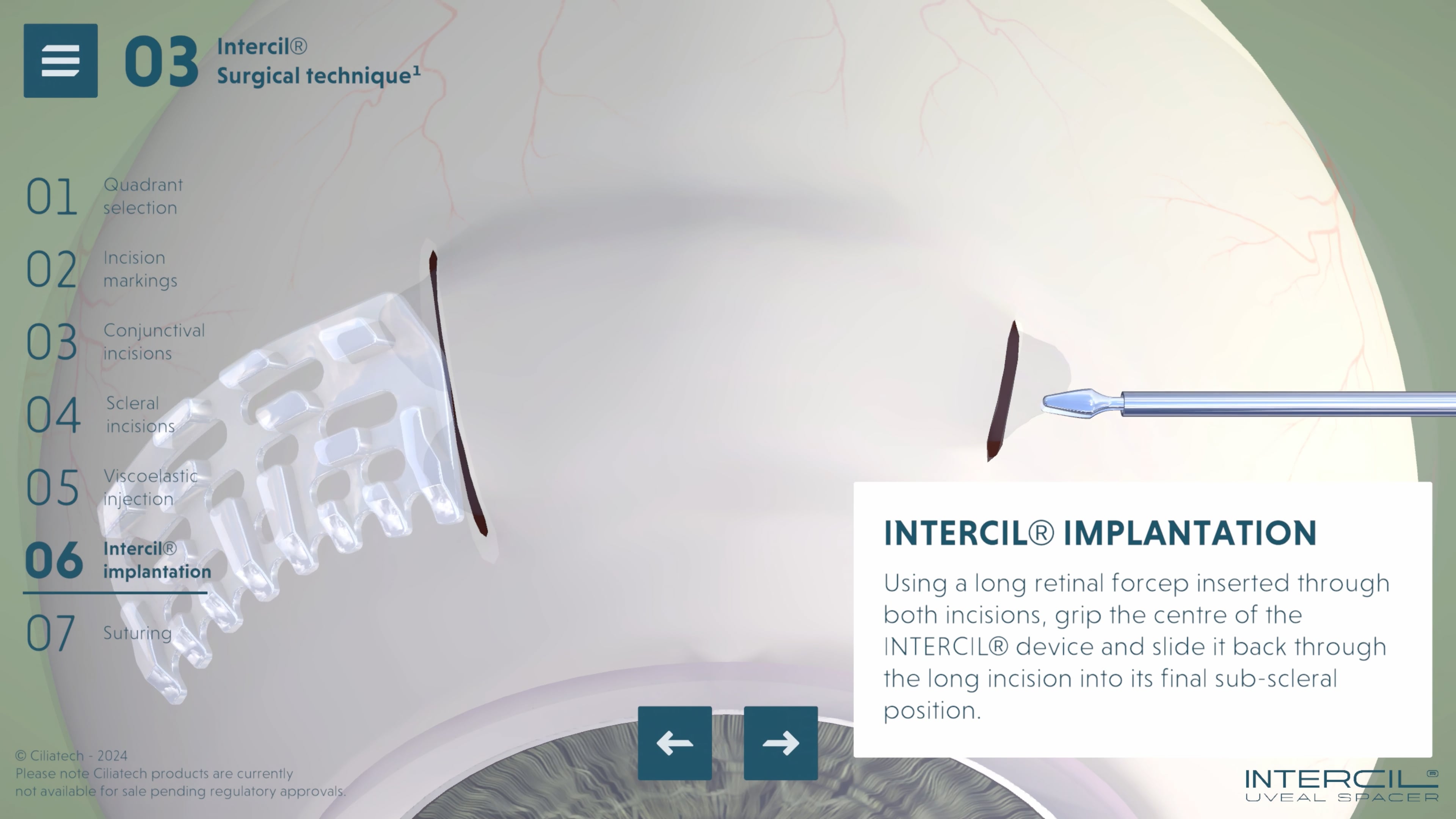 Intercil - Surgical Device Placement