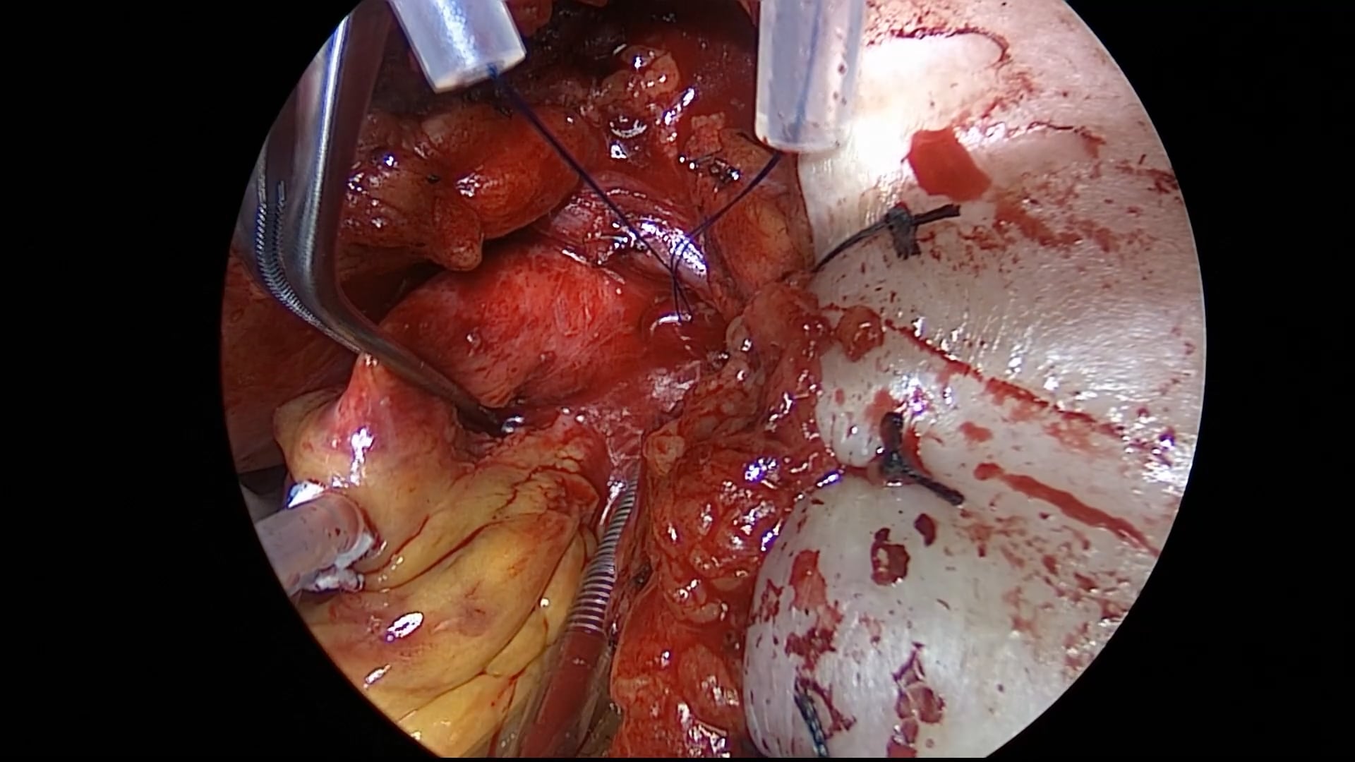 Removal of an intra-aortic thrombus | MMCTS