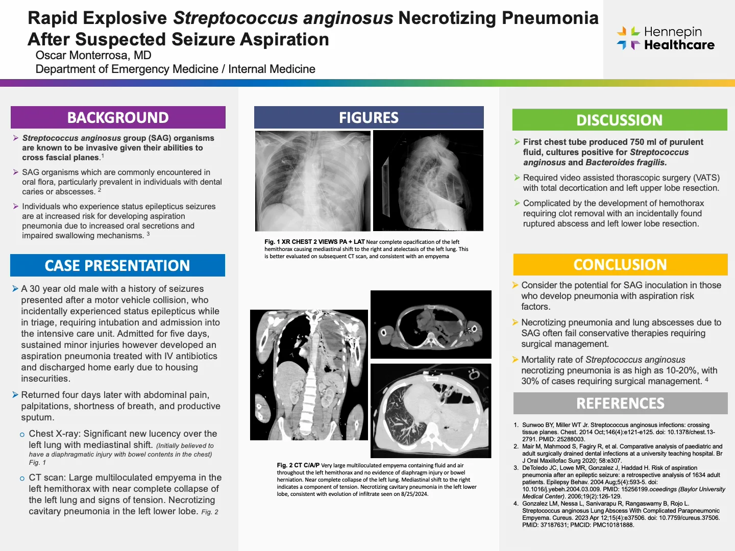 Rapid Explosive Streptococcus anginosus Necrotizing Pneumonia After ...