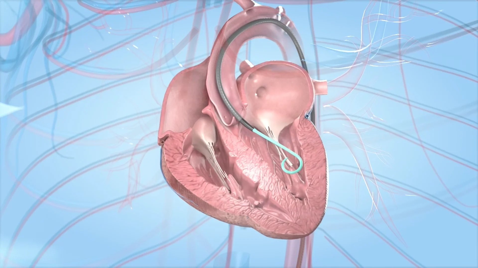 Ventrax™ Delivery System [In-Service]