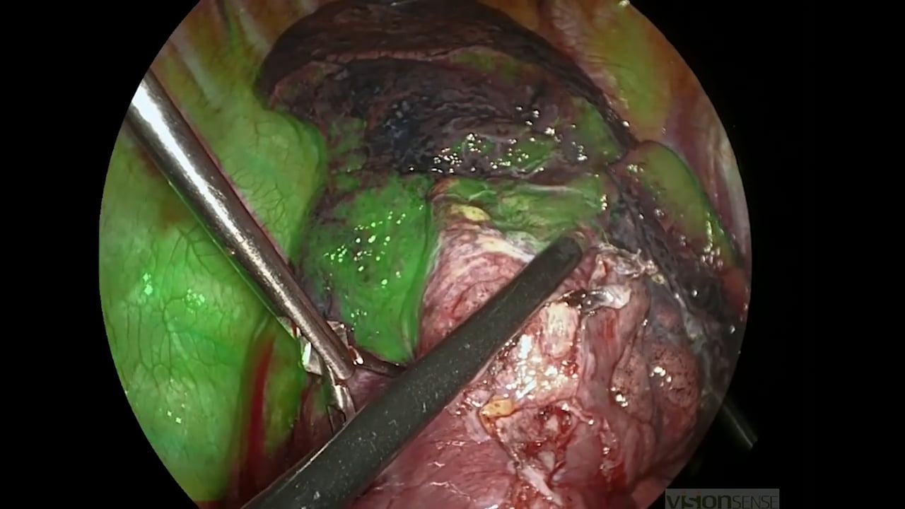 Thoracoscopic Non Anatomical Lung Segmentectomy For Intralobar Pulmonary Sequestration Using A 3