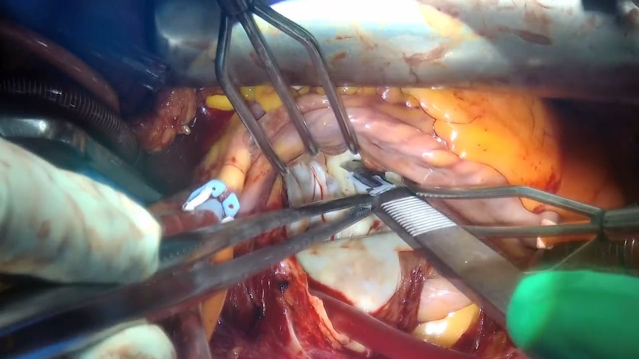 Emergency trans-mitral septal myectomy with resection of abnormal ...