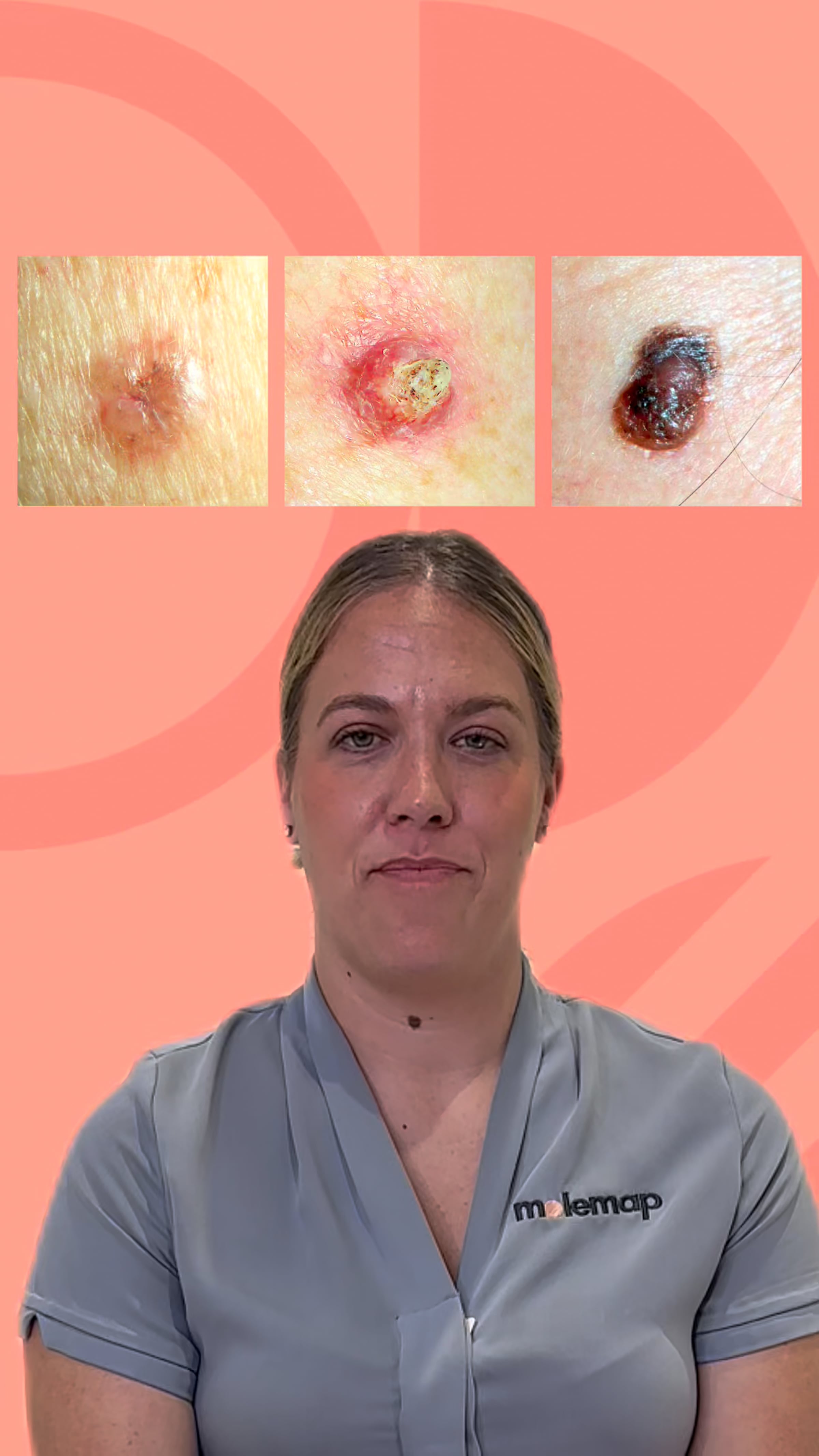 Types of skin cancer