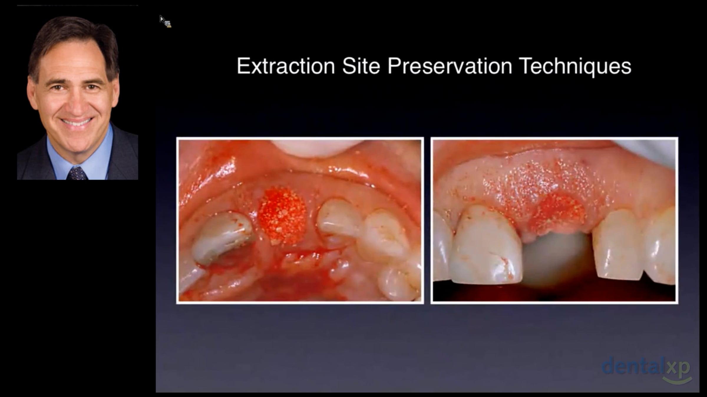 Optimum Implant Esthetics Through Extraction Socket Preservation ...