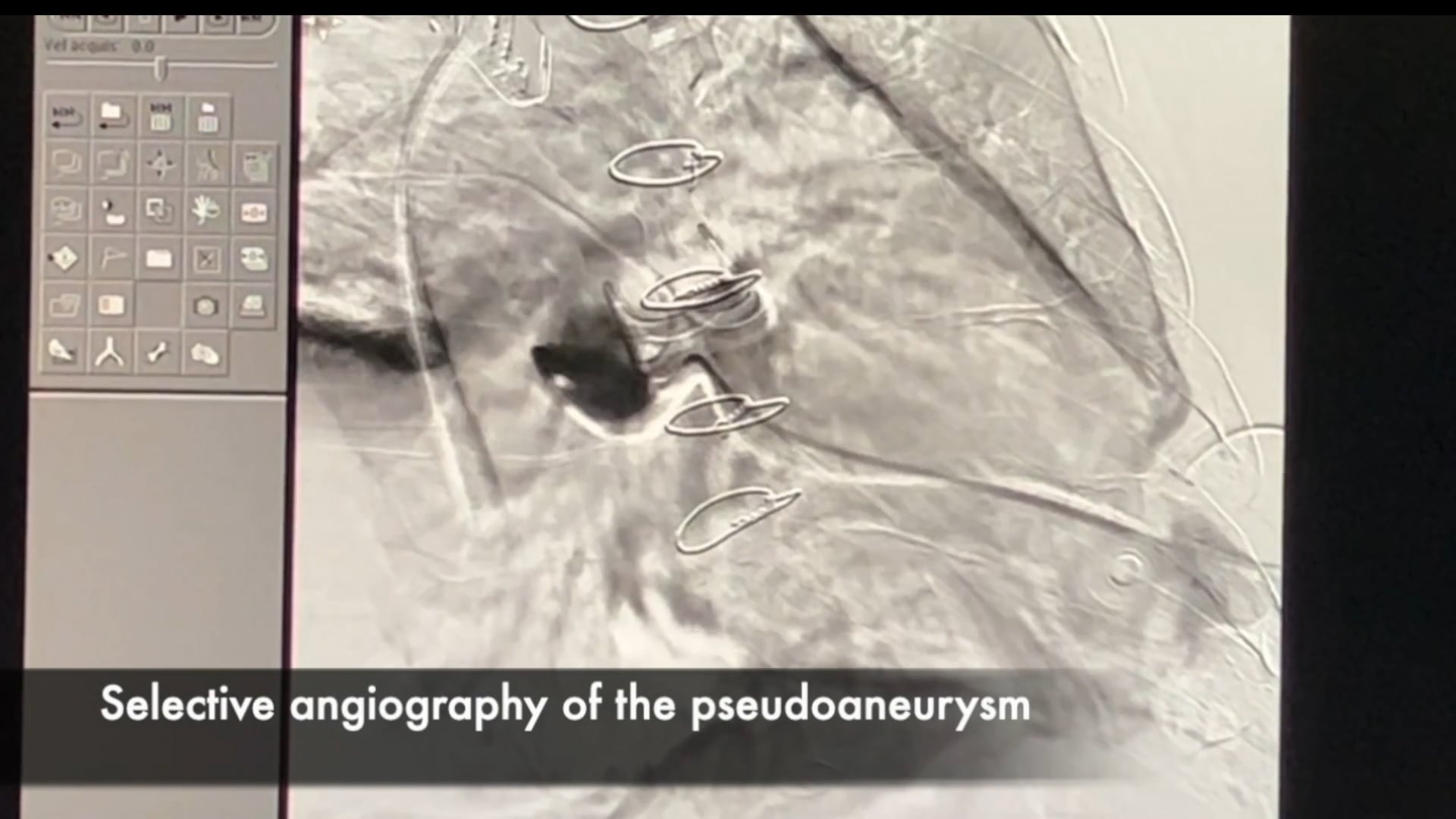 Transapical coil embolization for subannular aortic pseudoaneurysm | MMCTS