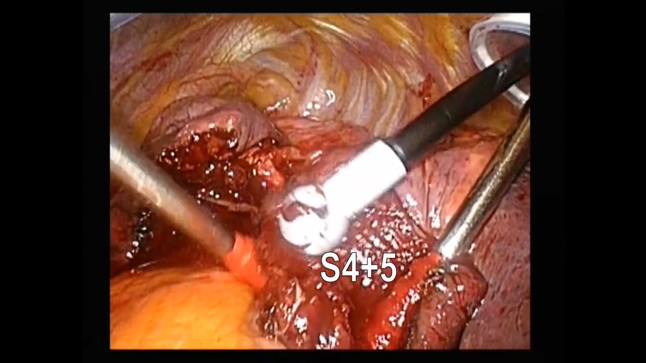 Anatomical left S3 pulmonary segmentectomy using blunt dissection guided by video-assisted ...