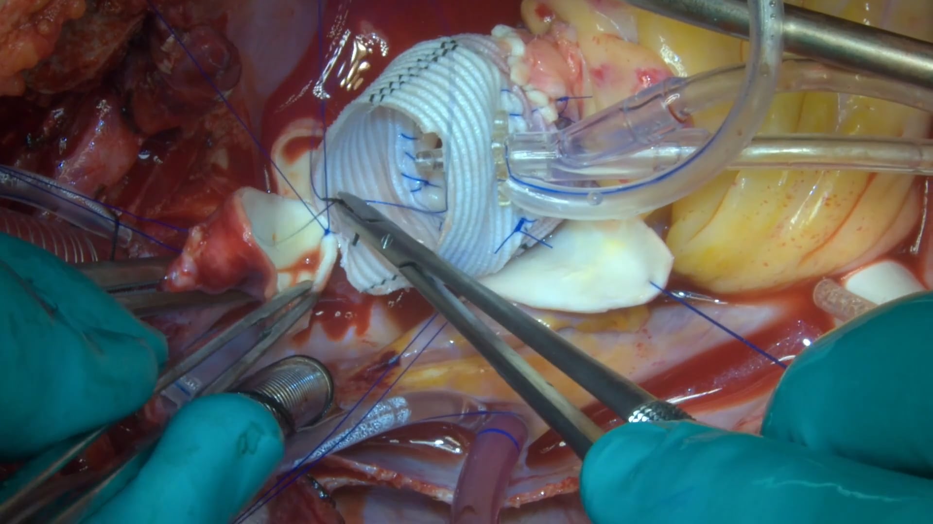 Total autologous reconstruction of the right and left ventricular ...