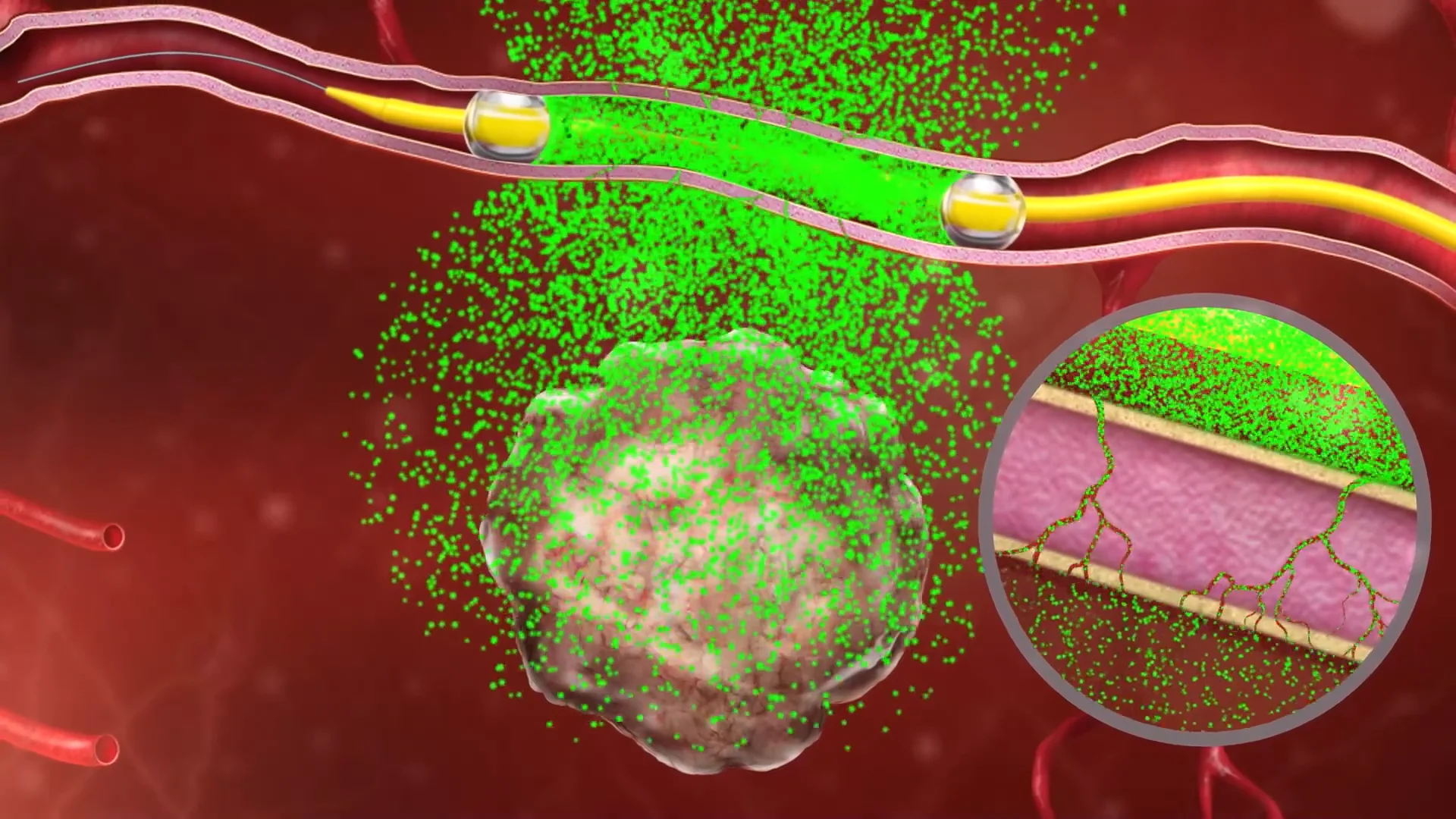 Delivering Therapy Where is Matters