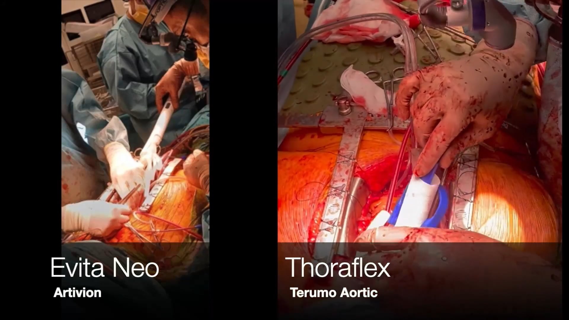 Beating heart arch replacement without circulatory arrest: a ...