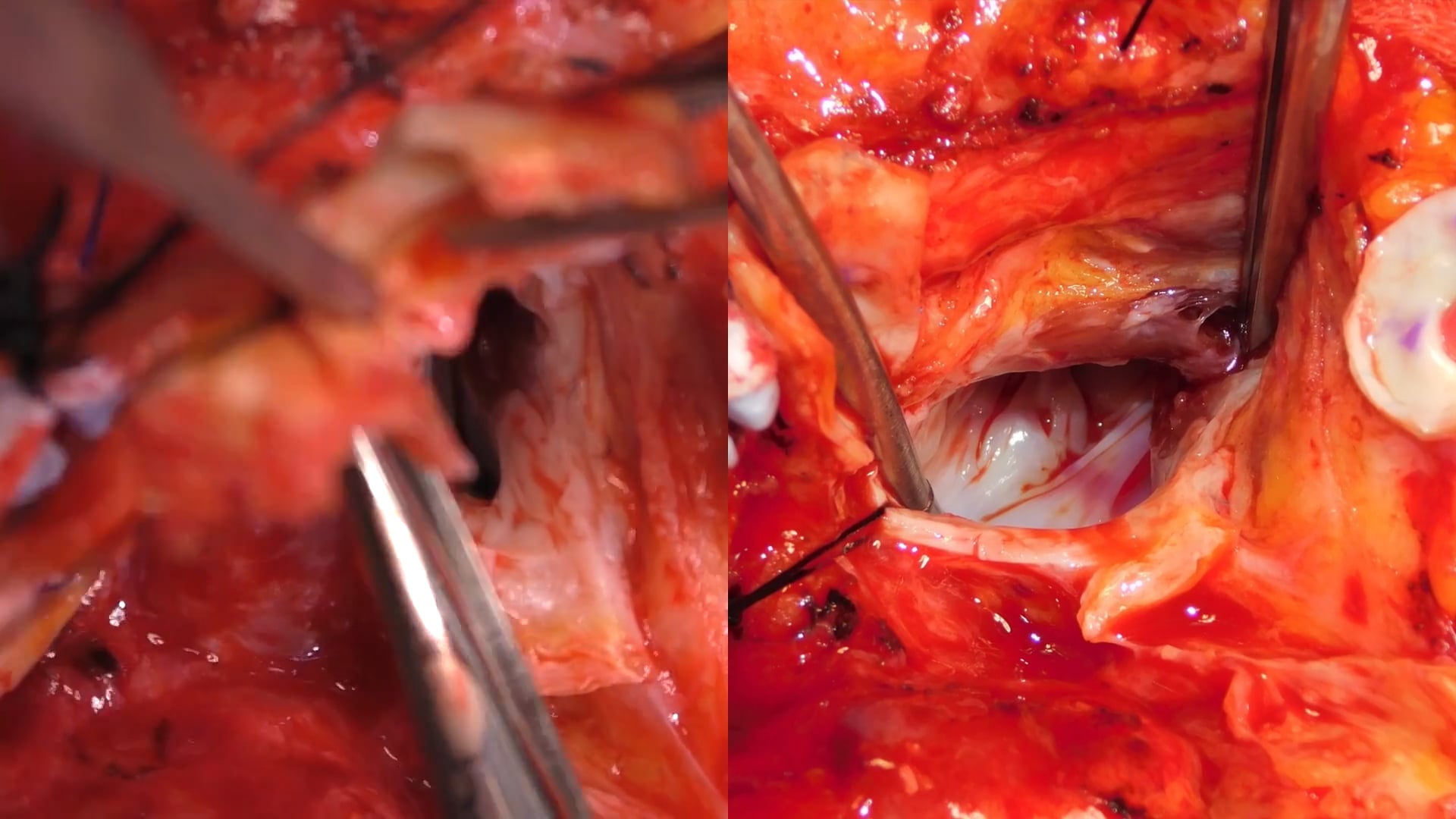 Recurrent subaortic membrane removal with homograft explant | MMCTS