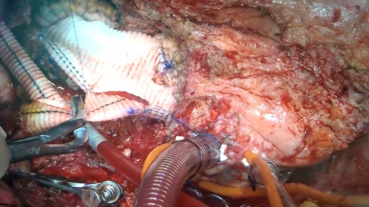 Staged repair for infected aortic arch graft and branched endograft ...