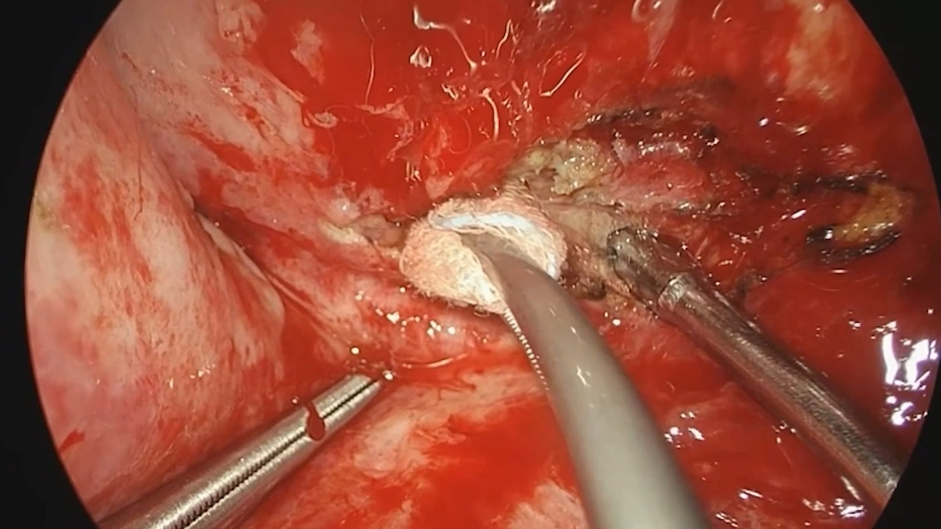 Post-traumatic chilothorax treated with thoracic duct closure guided by ...