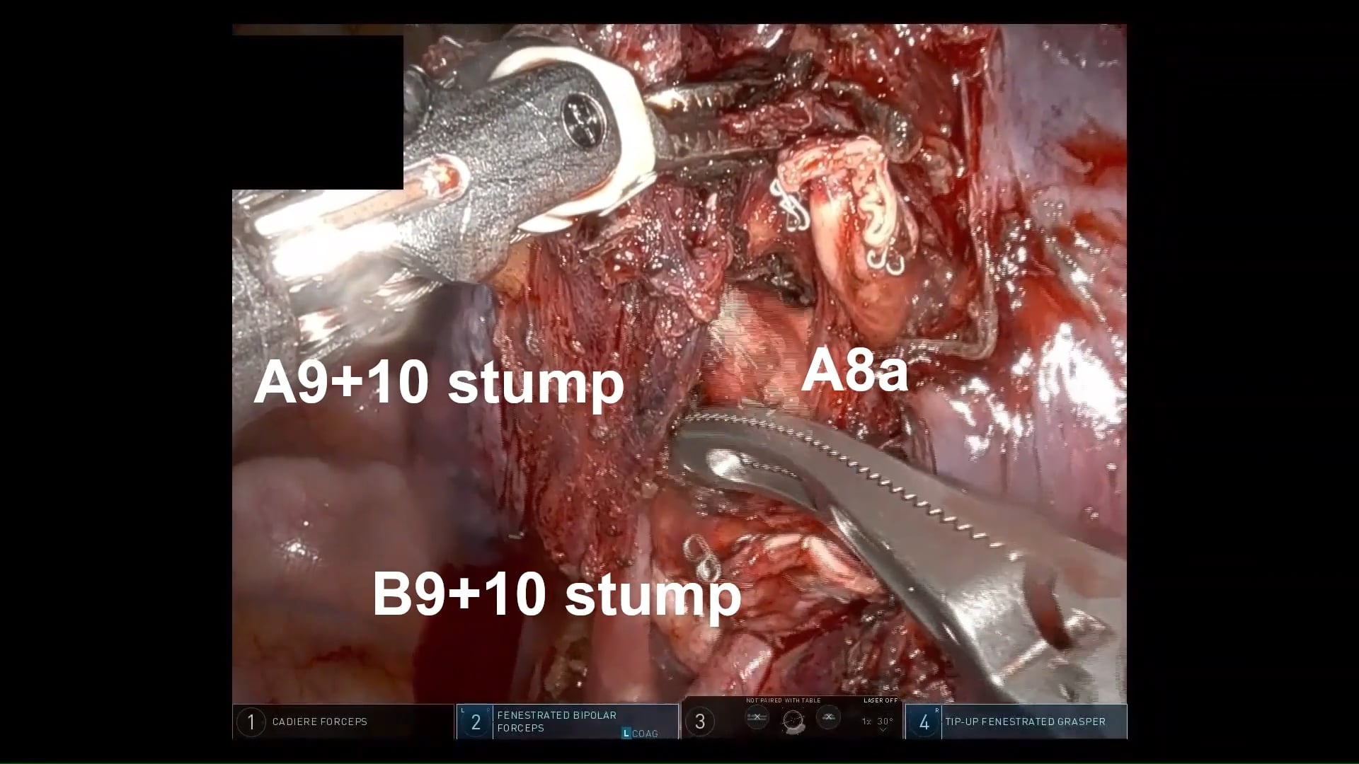 Feasibility of the lung base-flip approach for complex segmentectomy of ...