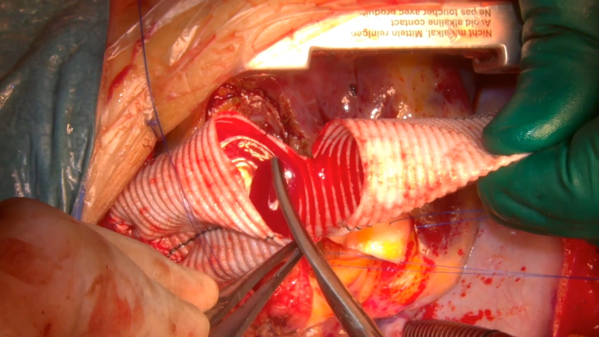 Modified Ross procedure with four different strategies for right ...