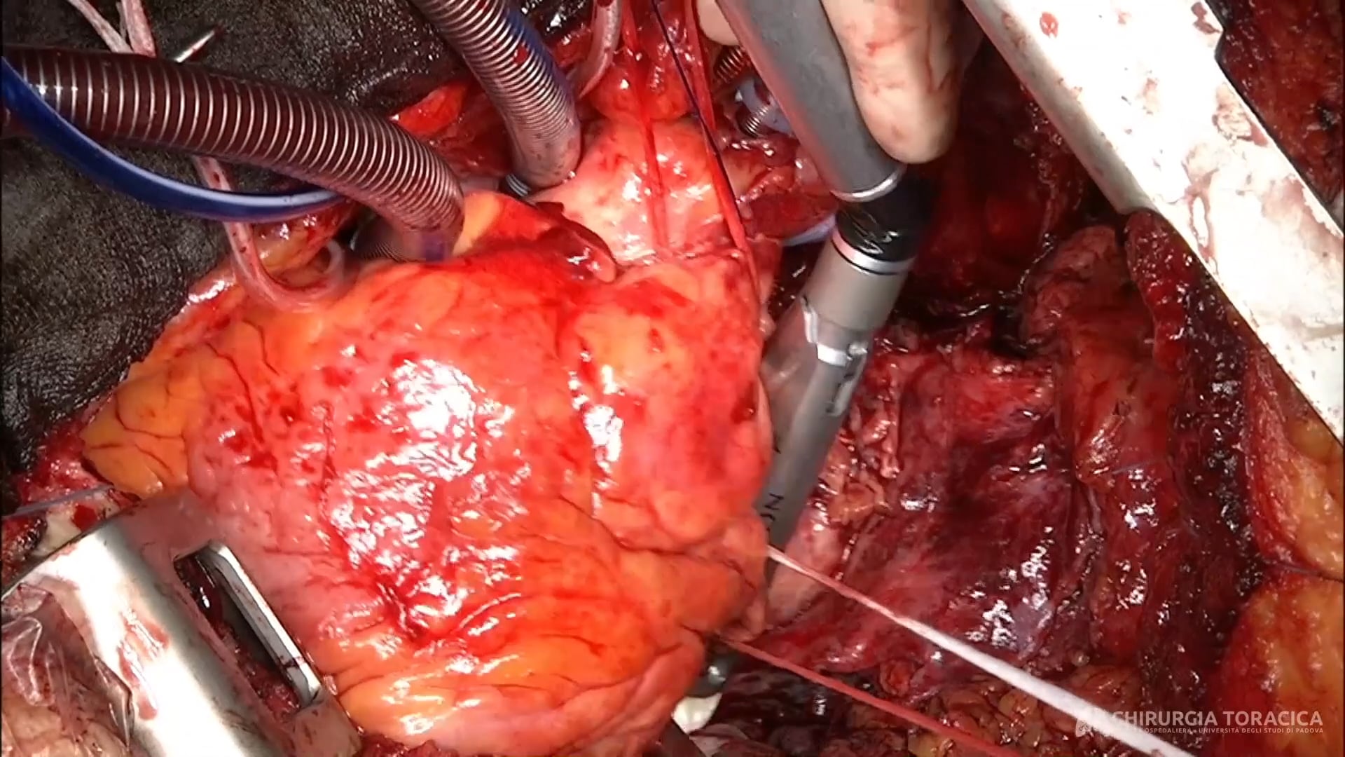 Extended left pneumonectomy with intrapericardial arterial ...
