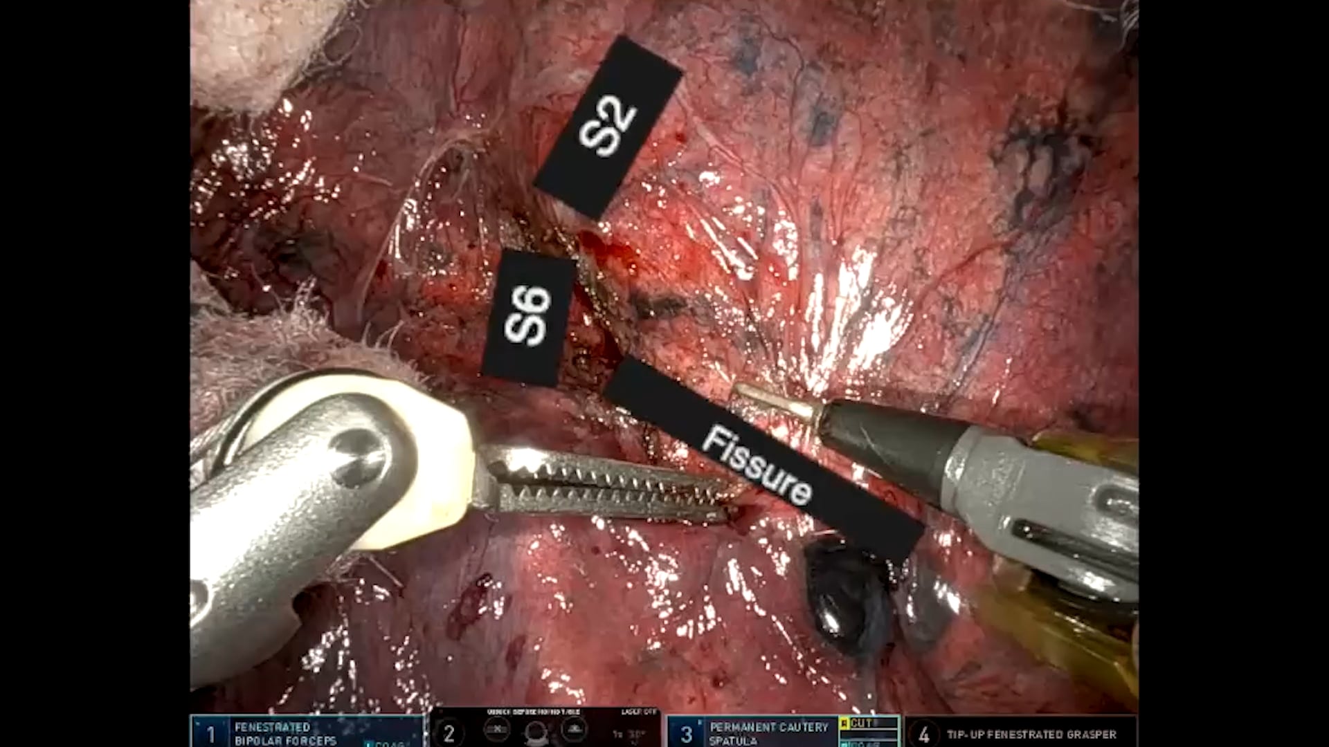 Right robotic-assisted thoracic surgery retrograde fissureless en bloc ...