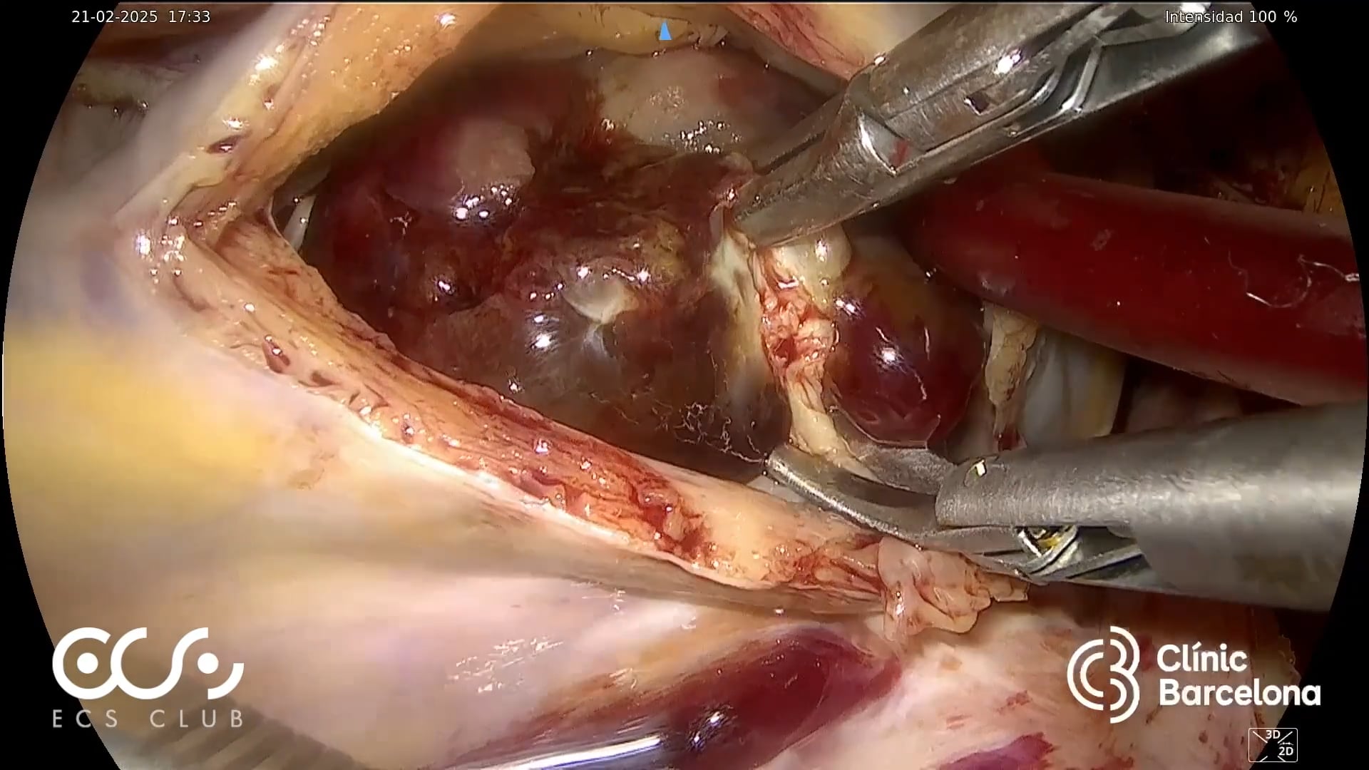 Giant right atrium myxoma resection: video-assisted thoracoscopic ...
