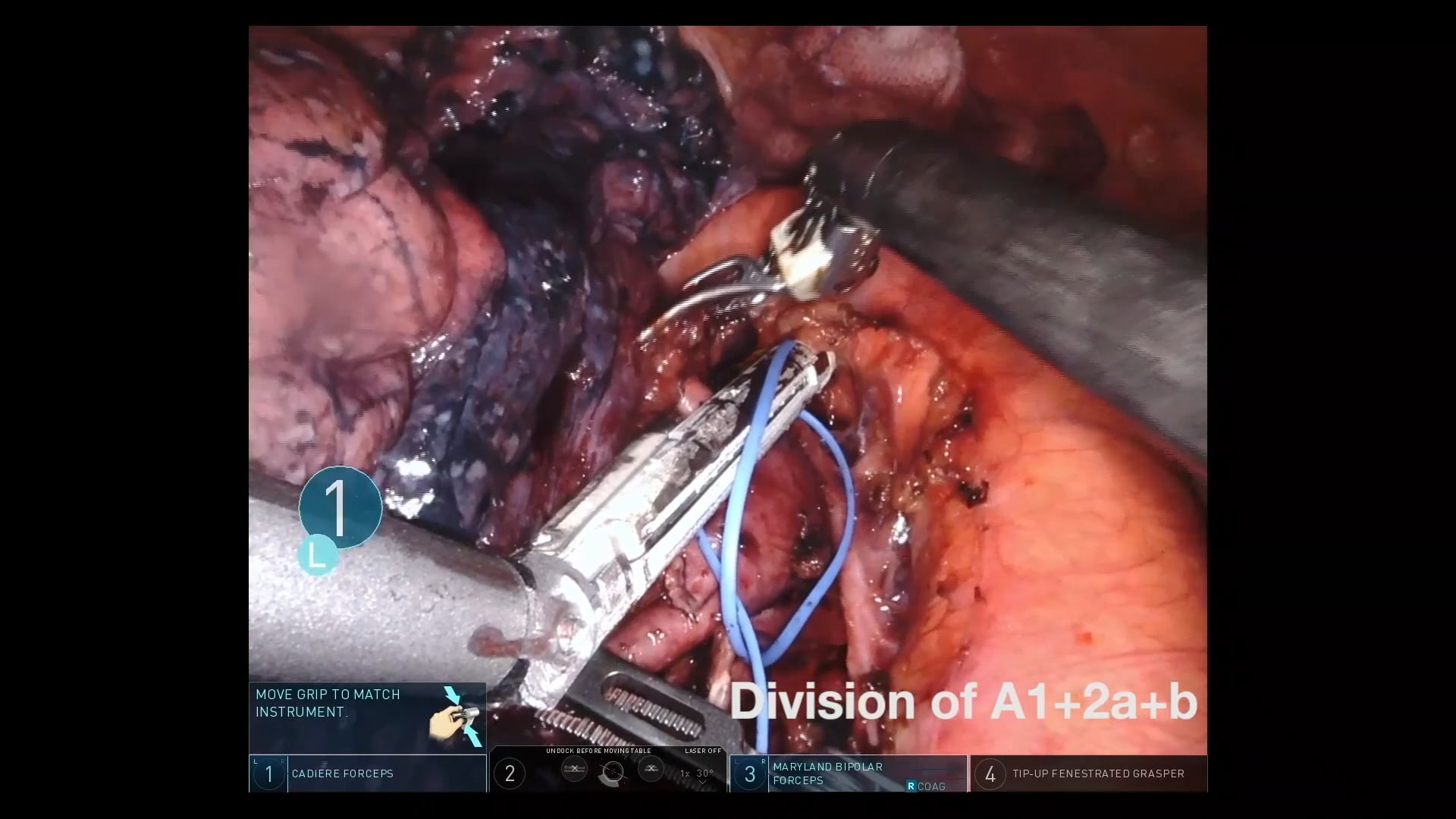 A robotic fissureless en bloc resection of left S6 and S1+2a+b for lung ...