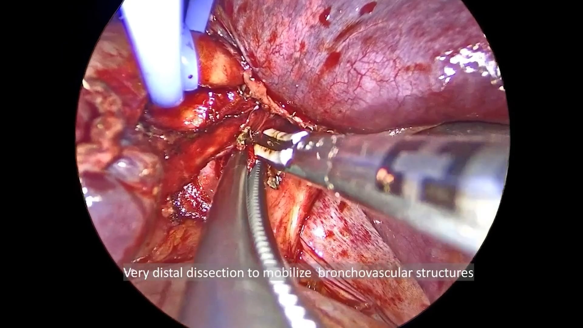 Uniportal Video Assisted Thoracoscopic Surgery Left S6 Sleeve Segmentectomy Mmcts