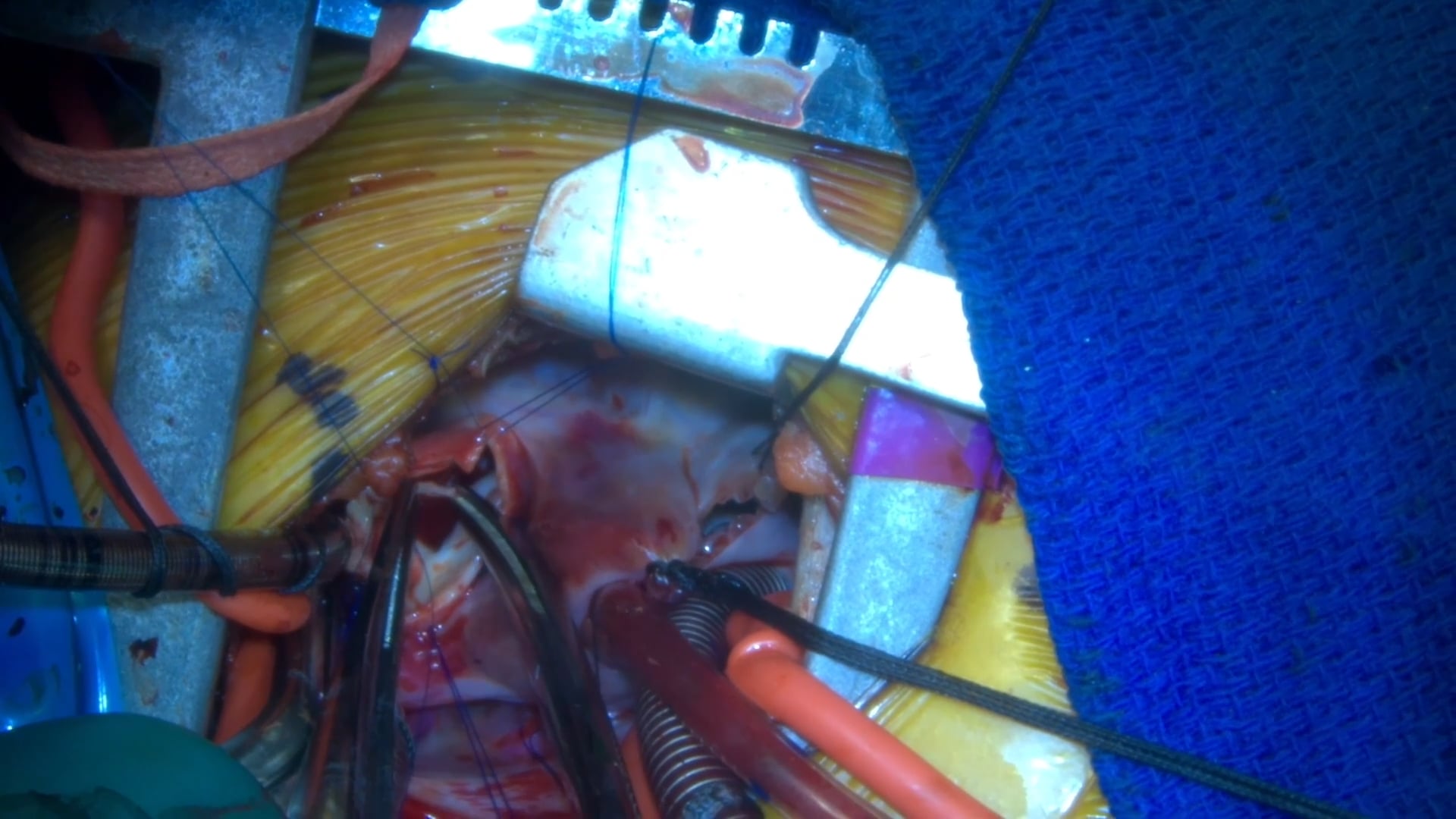 Minimally invasive resection of a subaortic membrane via a vertical ...