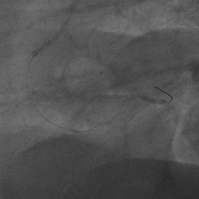 Distal Vessel Stenting in the PDA Vid D on Vimeo