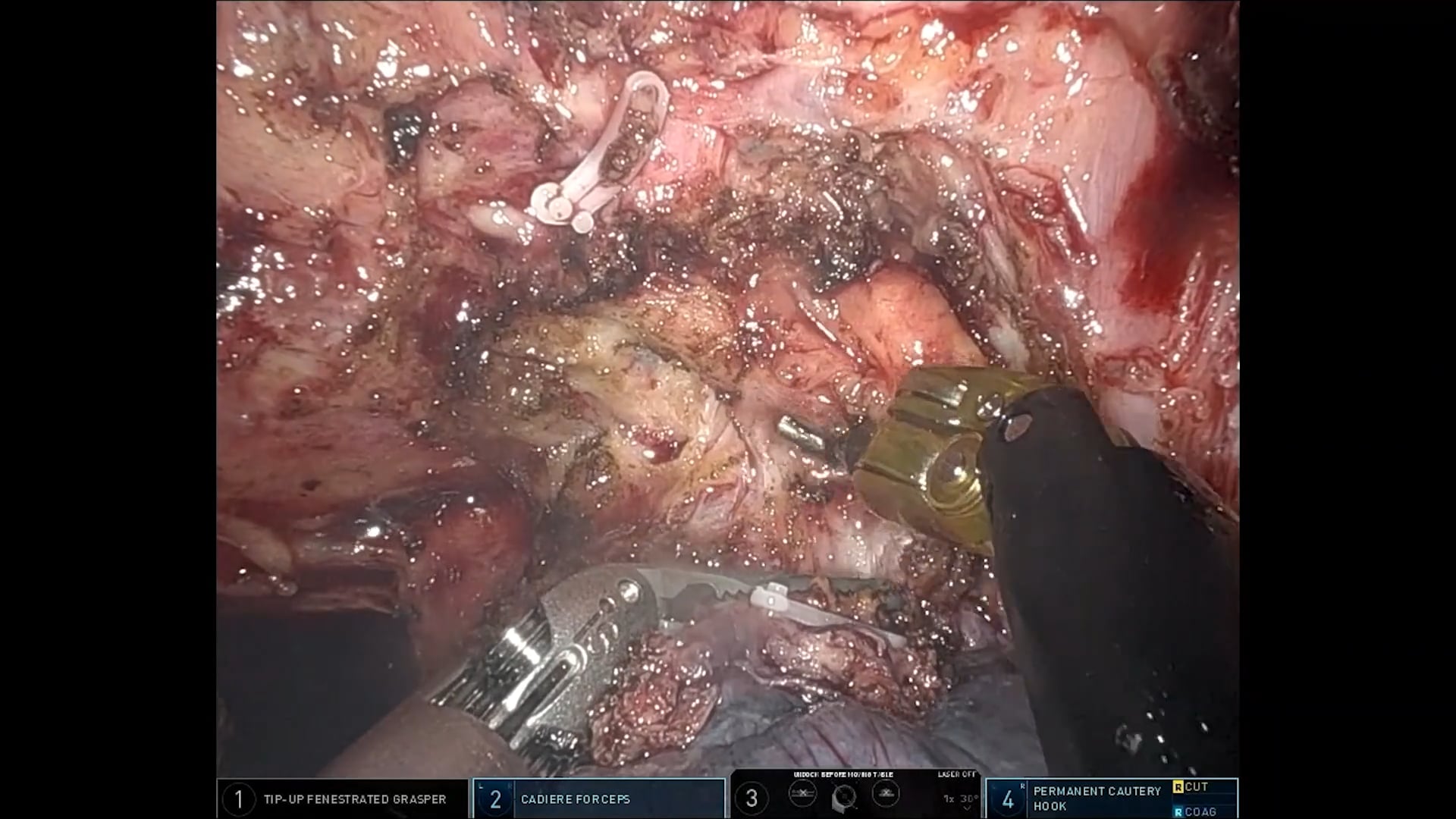 A robotic-assisted Pancoast tumour resection | MMCTS