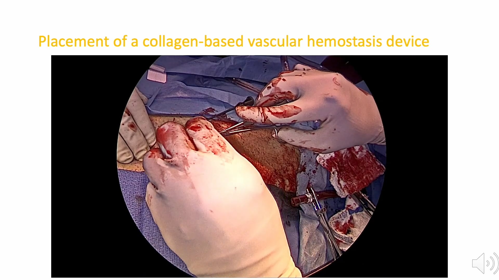 Modified percutaneous decannulation technique in veno-arterial ...