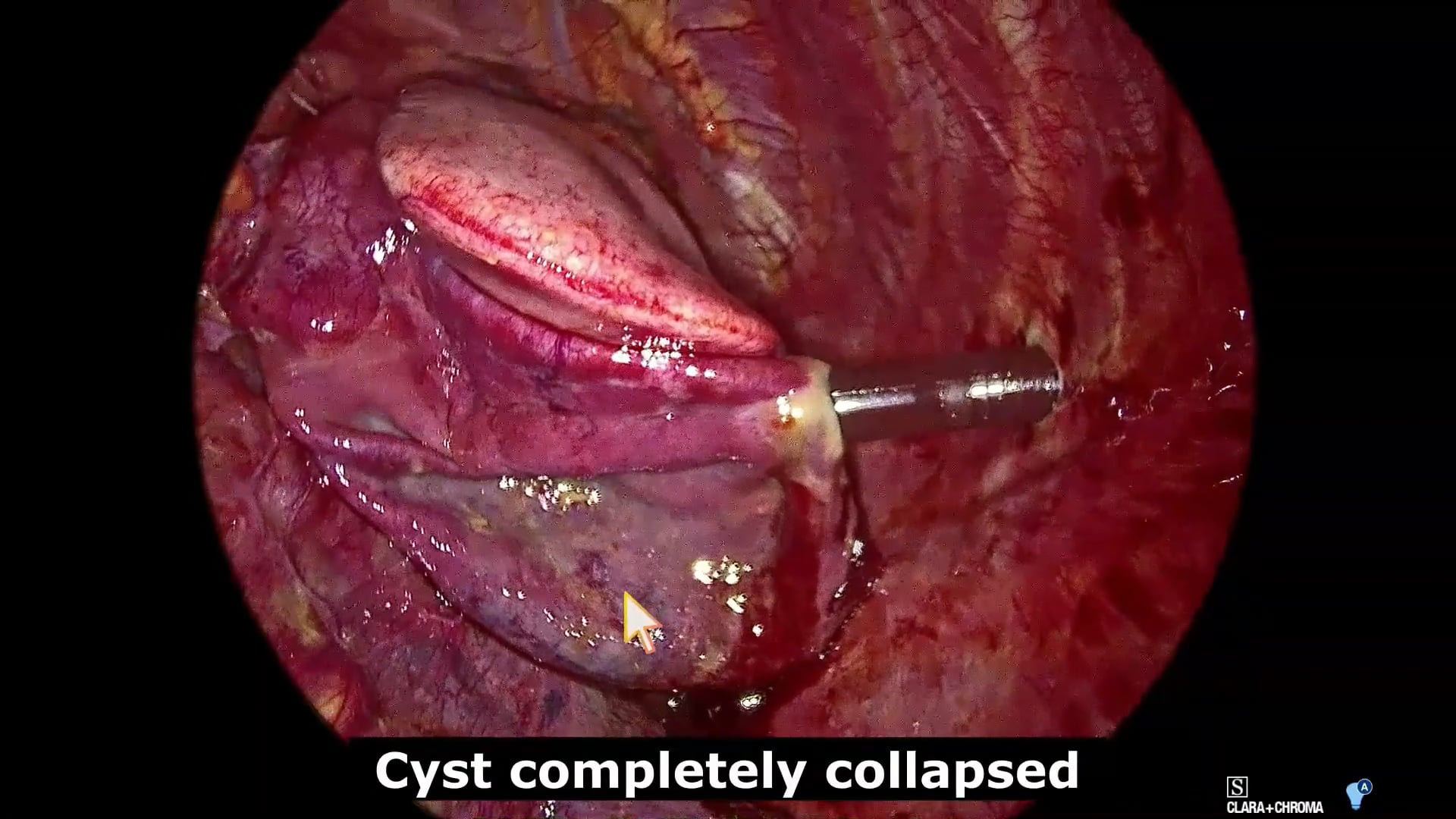 Video-assisted thoracoscopic excision of a bronchogenic cyst with a ...