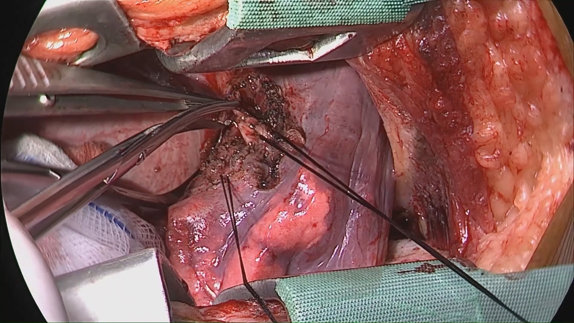 Tumour thrombus of the pulmonary arteries: the value of precise imaging ...