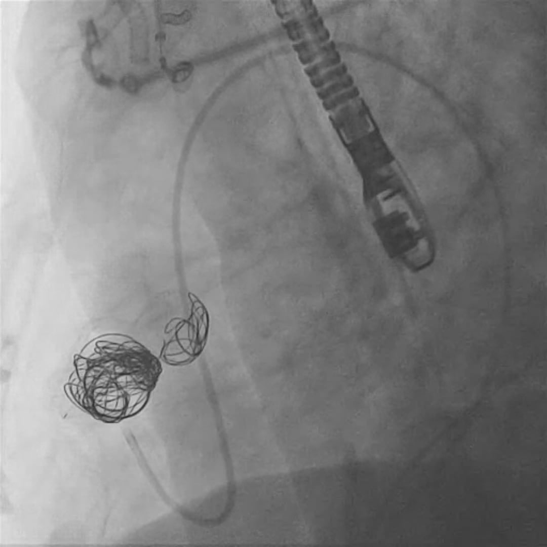 post-procedure-contrast-injection