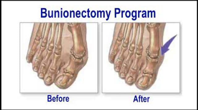 Podiatrist Austin TX - Bunionectomy Program on Vimeo