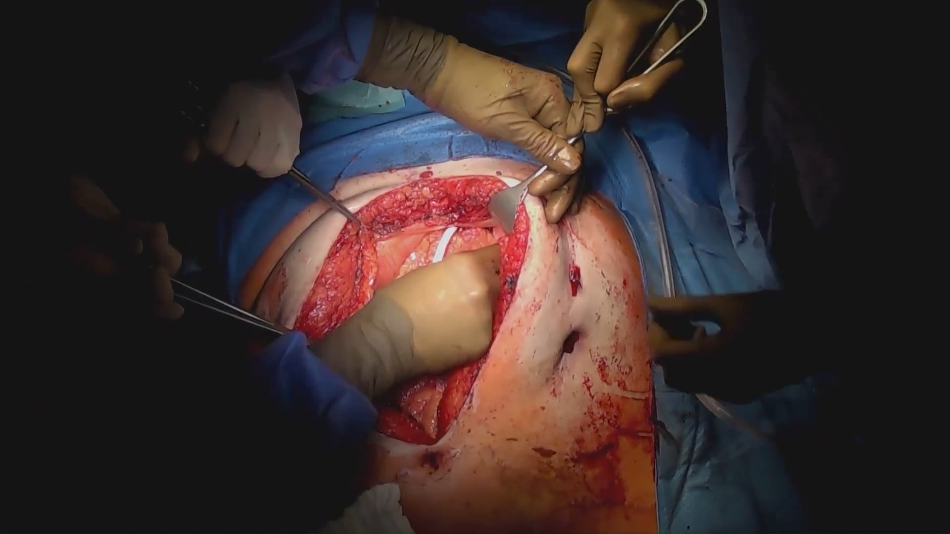 Driveline transposition with omentoplasty in a patient supported with a ...