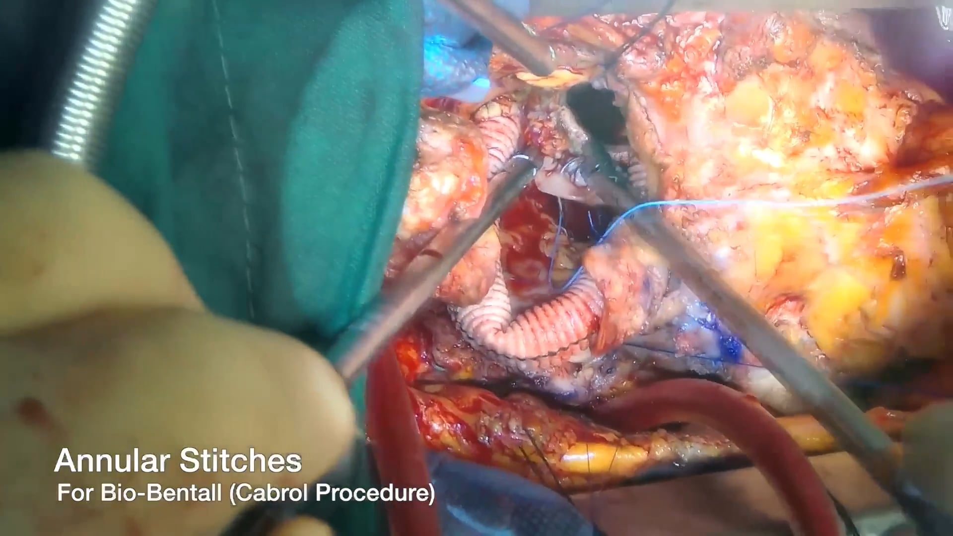 Redo aortic root replacement (Cabrol procedure) and Commando operation for extensive prosthetic ...