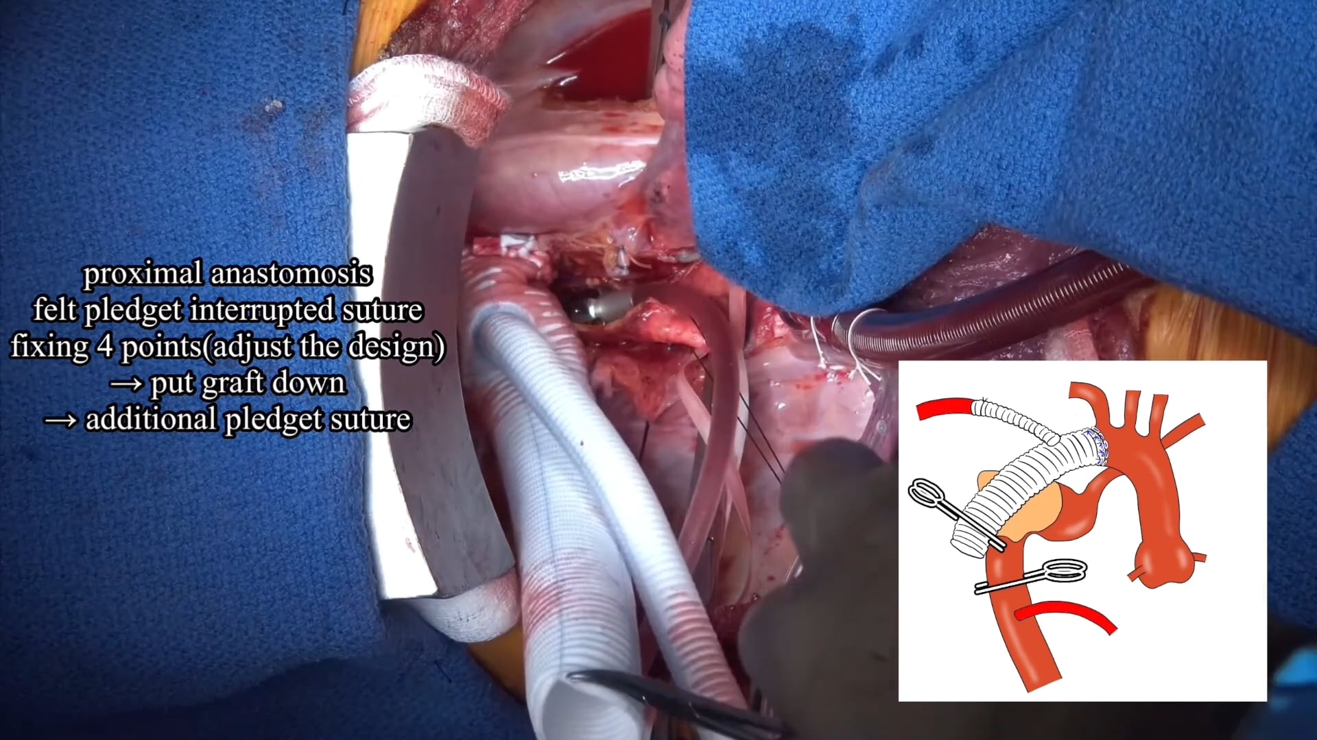 Right thoracotomy for surgical repair of Kommerell’s diverticulum with ...