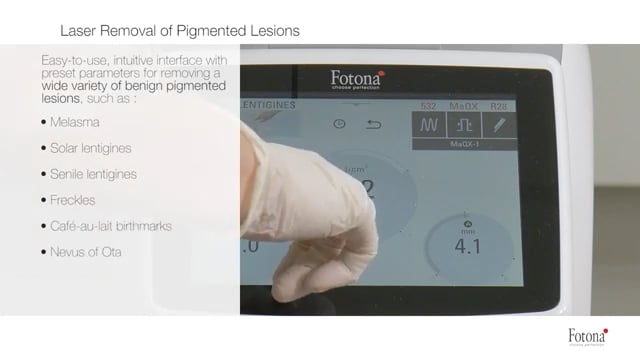 Laser Removal of Pigmented Lesions