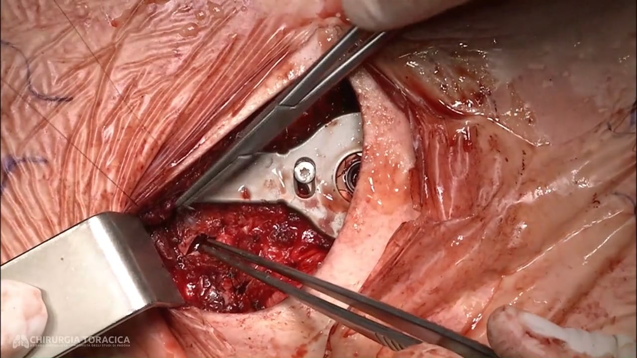 Pectus Up: a new technique for the correction of pectus excavatum | MMCTS