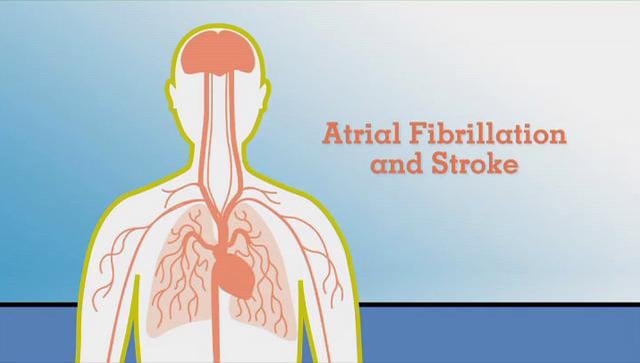 AFIB Stroke animation - National Stroke Association on Vimeo