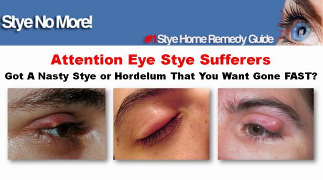 stye in my eye - treatment for eye stye - how to treat an eye stye on Vimeo