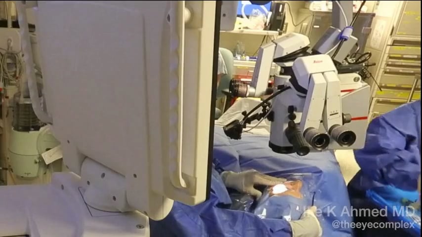 Elios Excimer Laser Trabeculostomy MIGS Procedure for Glaucoma(1 ...