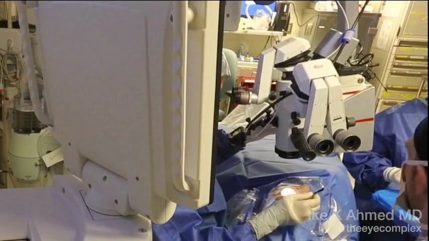 Elios Excimer Laser Trabeculostomy MIGS Procedure for Glaucoma(1 ...