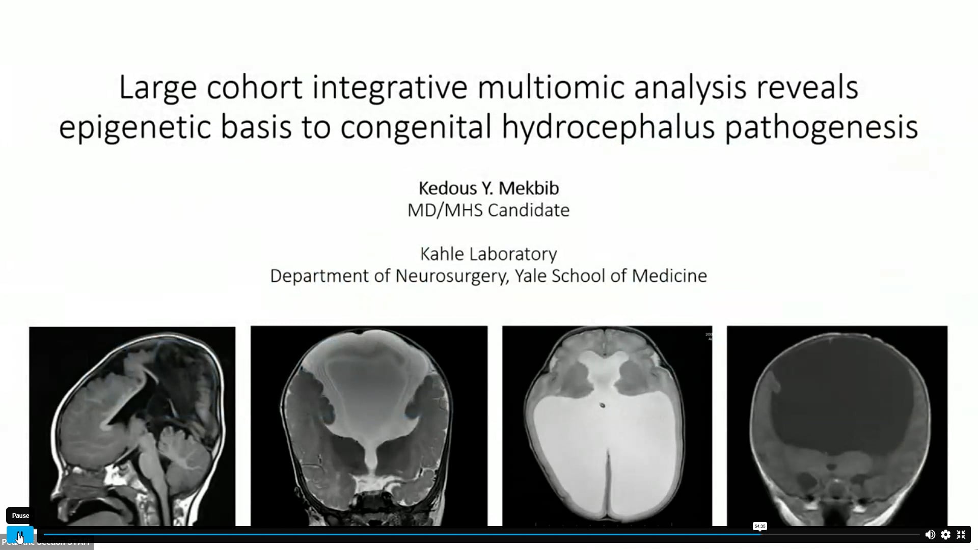 Large Cohort Integrative Multiomic Analysis Reveals Epigenetic Basis to ...